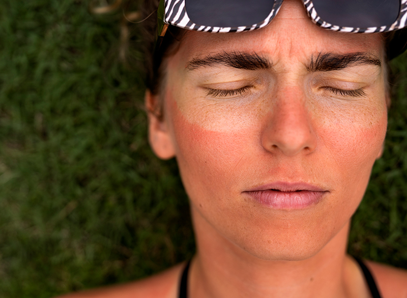 První pomoc při úpalu a úžehu: Co dělat krok za krokem | Natima